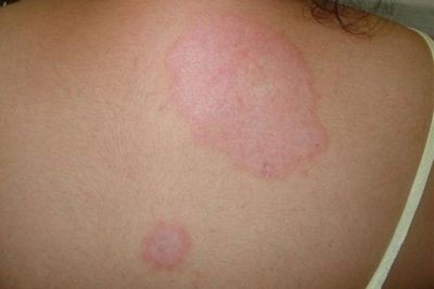 SES promove ações para orientar sobre como identificar e tratar a ...